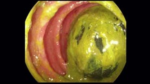 In this #DDW2021 ASGE real case video, see "Endoscopic Laser Lithotripsy as Management of Gallstone Ileus in a Non-Surgical Candidate." Take advantage of the full library available in GI Leap. http://ow.ly/PSlh50GEPKV #GIEndoscopy #Resources | American Society for Gastrointestinal Endoscopy - ASGE