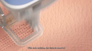 What is Ellacor? How Does This Technology Permanently Remove Excess Skin? This Video Explains!