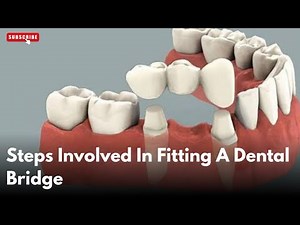 Steps Involved In Filling A Dental Bridge