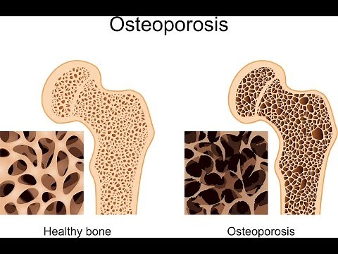 Osteoporosis