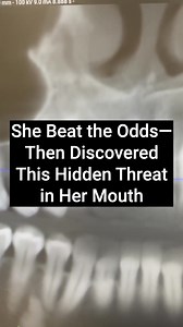 This patient was told she wouldn’t survive end-stage colon cancer. Two years later—she’s still here… and still fighting. 💪 But when a routine dental exam revealed not one—but two dead teeth linked to her liver meridian, she didn’t hesitate. 👉 “Get them out. I want to give myself the best chance to survive.” 🧠 Did you know that root canals can silently harbor infection—and impact your body’s ability to heal? Especially when they're connected to organs already under stress. Comment "directory" 