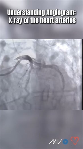 CardioVisual: Powered by MedicalVisual | 🩻 How do we X-ray the heart’s arteries? 🩻 Angiography gives us a real-time look inside the coronary arteries, helping identify blockages... | Instagram