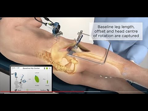 Intellijoint HIP® Lateral and Posterior by Intellijoint Surgical (Full)
