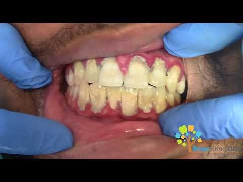 Dental Cleaning to remove heavy tartar🦷. 【Young Male first cleaning】