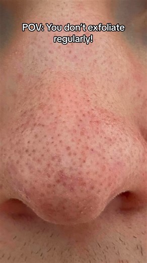 One go-to ingredient for eliminating blackheads is salicylic acid, a beta hydroxy acid that increases cell turnover and unclogs pores! Use Salicylic acid cleanser every morning. #blackhead #oilyskin #sebaceousfilaments #skincare #exfoliation | Dr. Farzan