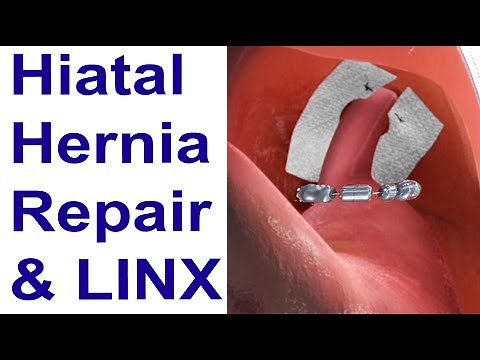 Hiatal Hernia Repair & LINX to Treat Reflux Animation