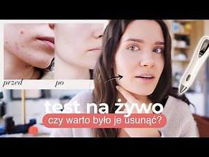 Jak usunęłam PIEPRZYKI i ZMIANY SKÓRNE - czy zostają blizny? czy to boli? jak wygląda zabieg?