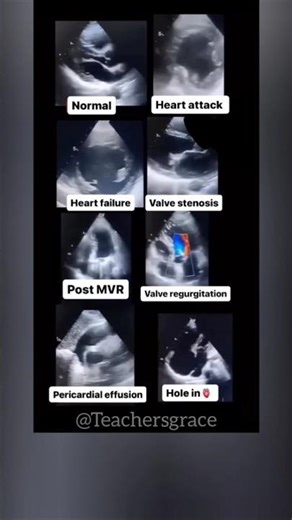 Echocardiogram Normal Vs Abnormal!#cardiology #3danimation #science #anatomy #shorts#viral #trending