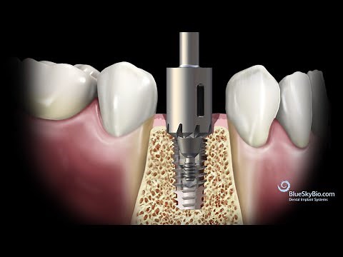 Blue Sky Bio Biomax Bone Profiler Drill Kit instructional video.