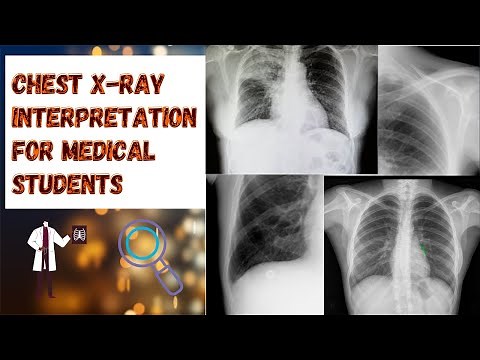Chest X-Ray Interpretation for Medical Students | ABCDE approach
