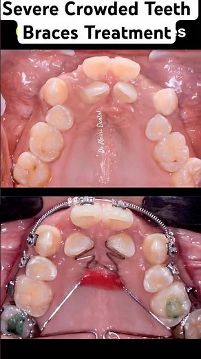 Braces , Expansion Devices Orthodontic Tips Video