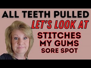 Immediate Dentures / Bad Sore From Dentures / Showing You My Gums Dentures Day 6