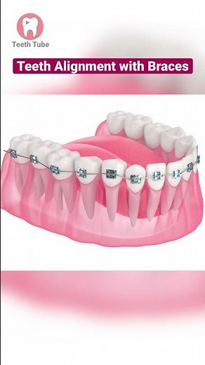Teeth Alignment with Braces (3D Animation) #shorts