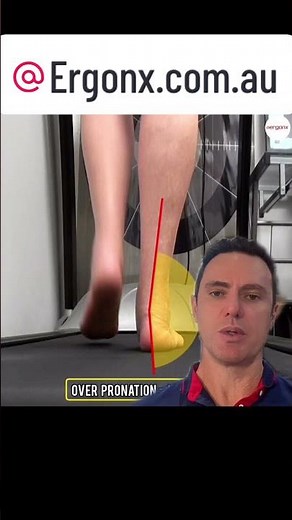Beat Overpronation: Protect Your Feet from Muscle & Joint Strain #FootHealth #OverpronationFix