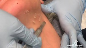 9 comments | Dermaplaning is a precise, manual exfoliation that has...