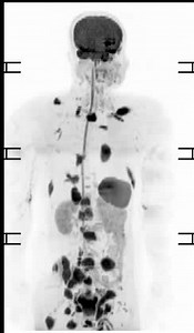 3K views · 11 reactions | Whole-body diffusion-weighted MRI (WB-MRI)...