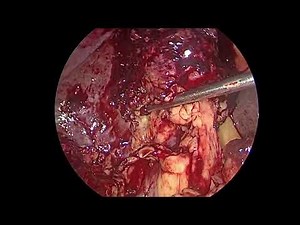 sub total cholecystectomy in a pt of hemobilia