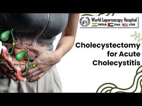 Laparoscopic Cholecystectomy in Acute Cholecystitis | Cystic Duct Ligation & Critical View of Safety