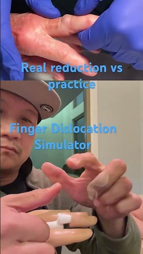 PIP dislocation reduction #fingerdislocqtion #athleictrainer