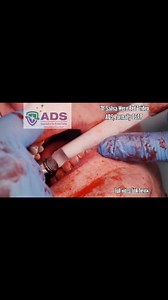 "If Saliva Were Red" video 🔴. The Association Dental Safety, ( ADS) infection control awareness video. What you can't see, can hurt you! Demand safe care from dental offices. Disinfection wipes and spray alone are not the standard of care. Plastic barriers must be used! Full educational video link: https://youtu.be/lDBTgiGvlS8?si=ExasmNdL2t9HIKSH9 #infectioncontrol #cdc #psa #ads | Deserving Dental