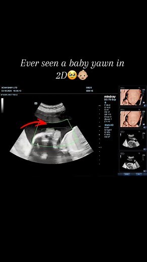 This gloomy weather’s got us feeling as sleepy as this adorable baby 🥱💤😂 It’s been a super busy day at the clinic with lots of gorgeous little ones to scan 😍💖 ✨ Next availability: Friday, 10am–6pm 🫶 We’re also open ALL weekend for scans at every stage of pregnancy: 👶 Early reassurance scans — from 6 weeks 💗 Gender reveal scans — from 15 weeks 🤰 Bonding scans — from 15–38 weeks 🌟 Magical 4D scans — from 24–32 weeks 📅 Book your slot today! 🌐 www.scanbaby.co.uk 📞 01623 272 662 #ScanBab