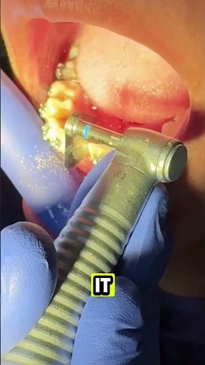 IPR and Braces - Interproximal Reduction - Toothtime Family Dentistry New Braunfels