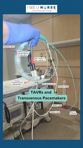 Why does your TAVR patient have a temporary transvenous pacing wire? Transcatheter Aortic Valve Replacement (TAVR) is a minimally invasive procedure used to treat severe aortic stenosis. Patients who undergo this procedure will have a temporary transvenous pacing wire inserted via the femoral vein through a sheath/introducer. The TVP will be used, primarily, to rapidly pace the right ventricle to allow for safe deployment of the balloon-expandable valve. Although some new data is discussing paci