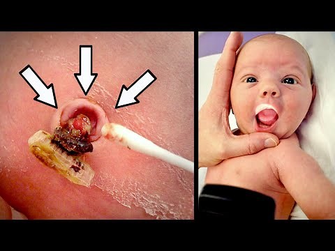 GNARLY UMBILICAL GRANULOMA! (Super Chill Newborn) | Dr. Paul