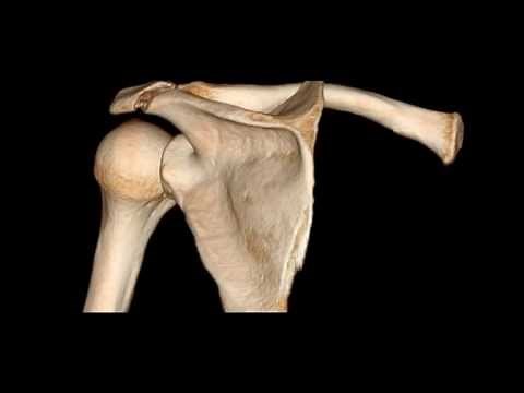 Fracture of Acromion Process of the Scapula
