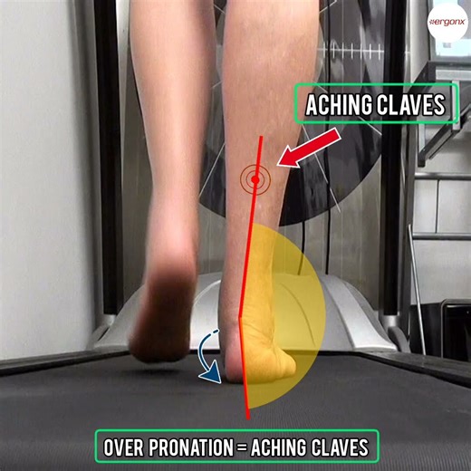 Overpronation causes arching calves