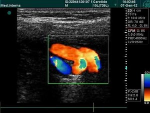Vascular Coiling In Doppler Examination • Video • MEDtube.net