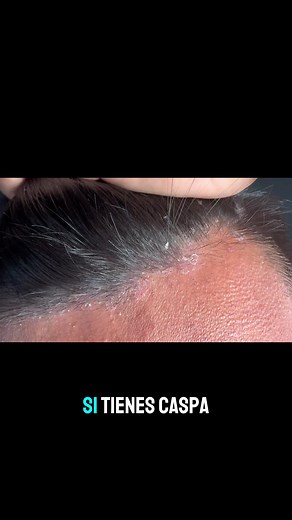 #caspa #caspa #caspa #caspa #caspa #caspa #tratamiento #tratamiento #bueno #barato #bueno #barato #bueno