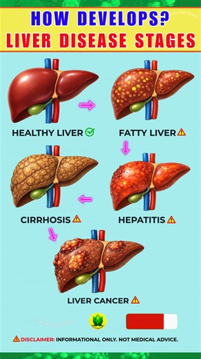 ✅ Stages of Liver Disease Explained | From Healthy Liver to Liver Cancer The liver is one of the most resilient organs in the body—but it can also be silently damaged for years without noticeable symptoms. By the time warning signs appear, the disease may already be advanced. In this video, you’ll learn the full progression of liver disease, starting from a healthy liver to fatty liver, hepatitis, cirrhosis, and liver cancer. Understanding these stages can help you recognize early risks, and lif