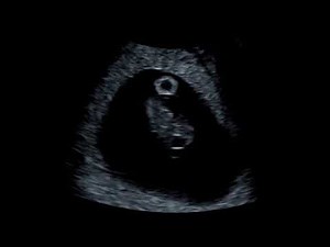 What Can You See At An 8 Week Baby Scan?