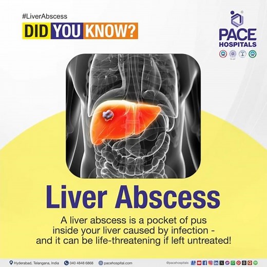 Liver Abscess - Causes, Warning Symptoms, Diagnosis, Treatment and Prevention Tips #liverhealth