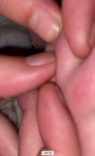 Perfect blackhead #blackhead #pimple #pimplepopping #pimplepopperaddict #satisfyingvideo #fyp #smallspot #badhabbit