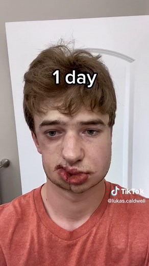 It took over 7 months, but I am finally 100% back to normal