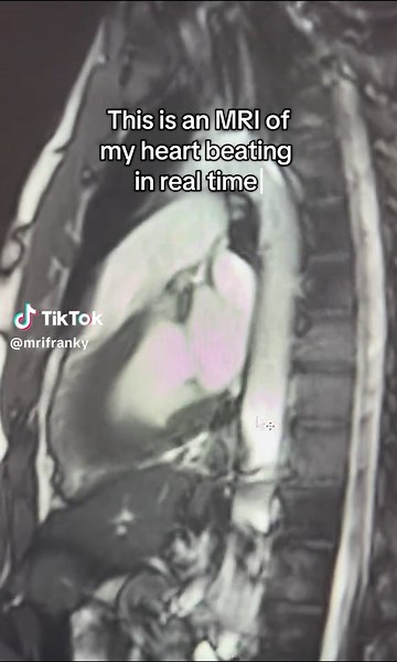 Real-Time Cardiac MRI: Heart in Motion