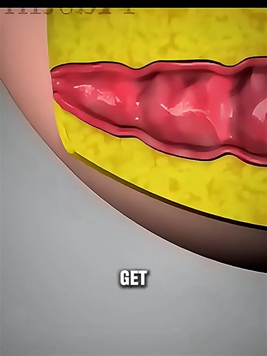 Piles Examination & Surgery Explained #piles #hemorrhoids #pilessurgery #medicalanimation
