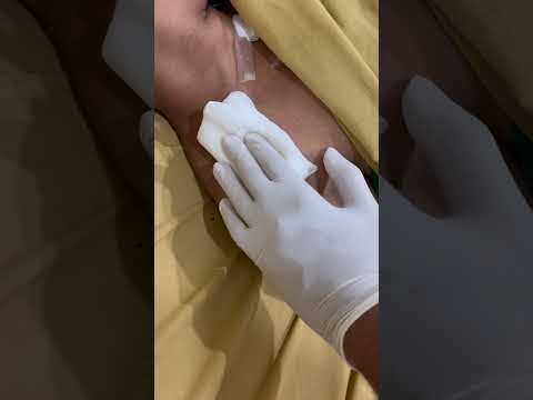 Central line removal