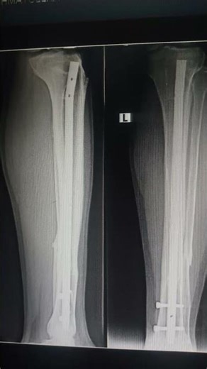 Leg x ray position #drshery#radiologiest