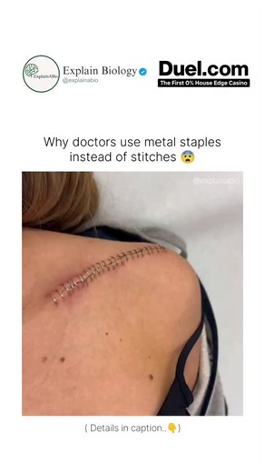 BIOLOGY | MEDICAL | LIFE on Instagram: "These metal clips are called surgical staples — used to close deep or long wounds faster than traditional stitches. They help the skin heal neatly and reduce the risk of infection. Doctors use a special stapler to attach them and later remove them painlessly once healing begins. It might look scary, but it’s one of the smartest healing techniques in modern surgery! Follow us @explainabio for more ✨ . . . . . . . . . . . . . . . . #MedicalFacts #SurgeryExpl