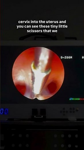 A hysteroscopy is a minimally invasive procedure that allows your doctor to look directly inside the