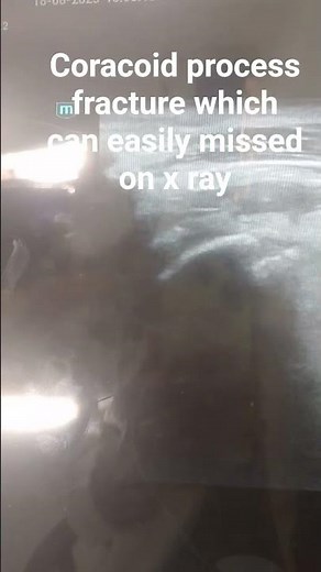 coracoid process fracture