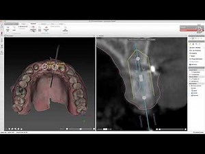 Import IOS Stl scan and create virtual tooth setup in DTX Implant Studio
