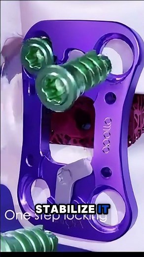 ACDF (Anterior Cervical Discectomy & Fusion)