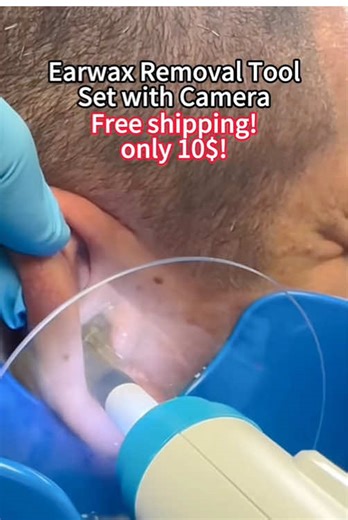 If you're not using these, START😅 ear wax removal tool with camera earcleaning #earwax #eardrum #earwaxremovaltool #tiktokshopdeals #tiktokshopfinds #tiktokshoploveatfirstfind