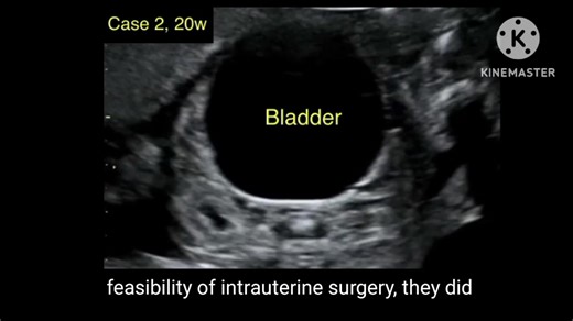 Urethral obstruction | Radiology Interesting