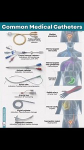 ❇️ Types of Catheters & Their Indications: ▶️ Foley catheter Used for bladder drainage in urinary retention and for accurate urine output monitoring. The balloon anchors the catheter inside the bladder. ▶️ Central venous catheter (CVC) Inserted commonly into the internal jugular vein. Used in ICU settings for central venous pressure monitoring, administration of vasopressors, total parenteral nutrition, and long-term intravenous medications. ▶️ Dialysis catheter Placed preferably in the internal