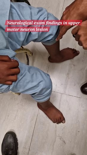 16K views · 325 reactions | Neurological examination In upper motor neuron lesion | Dr. Arshad Mehmood - Child Specialist | Facebook